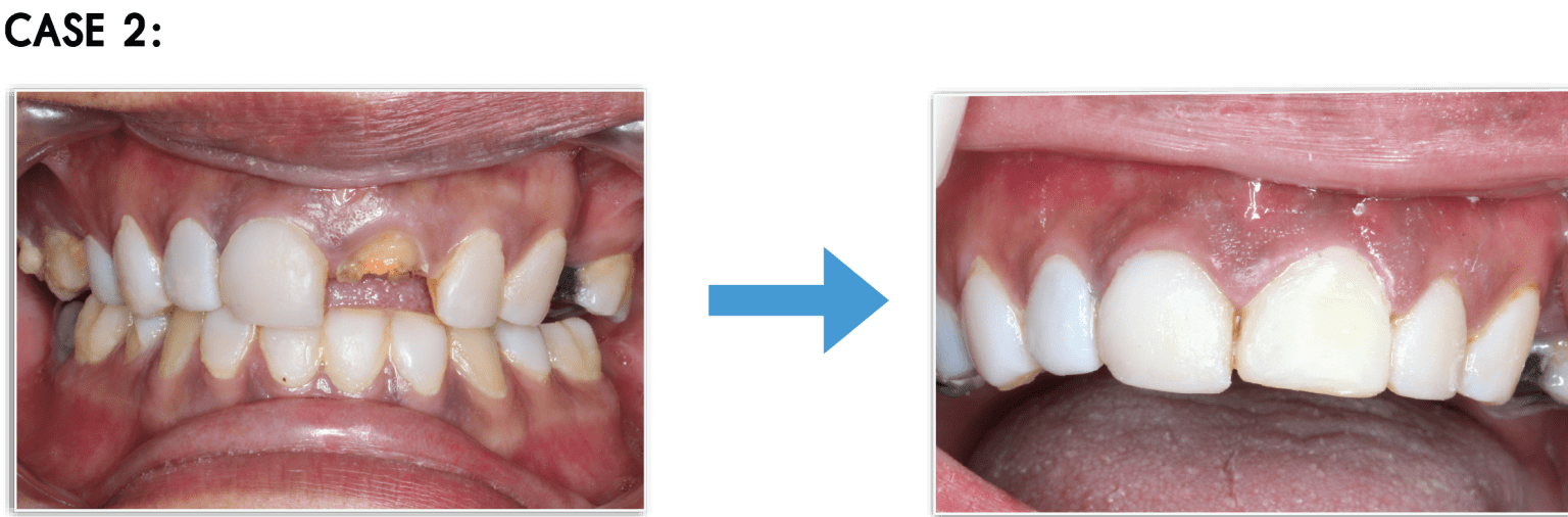 IMPLANT LOADING WITH AN IMMEDIATE CROWN WITHIN 1-HOUR