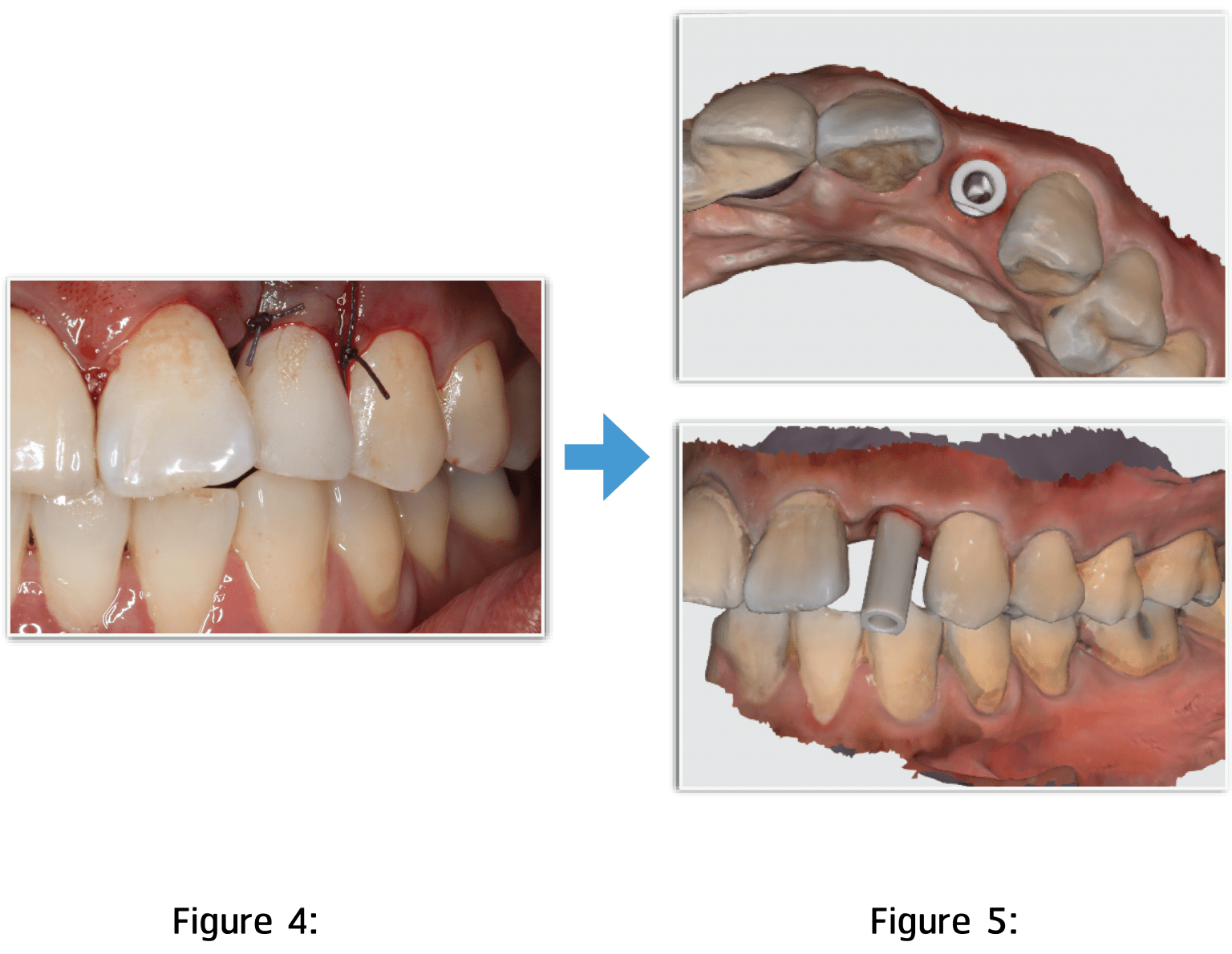 IMPLANT LOADING WITH AN IMMEDIATE CROWN WITHIN 1-HOUR