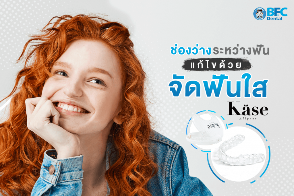 ช่องว่างระหว่างฟัน แก้ไขด้วยจัดฟันใส Käse Aligner - BFC Dental