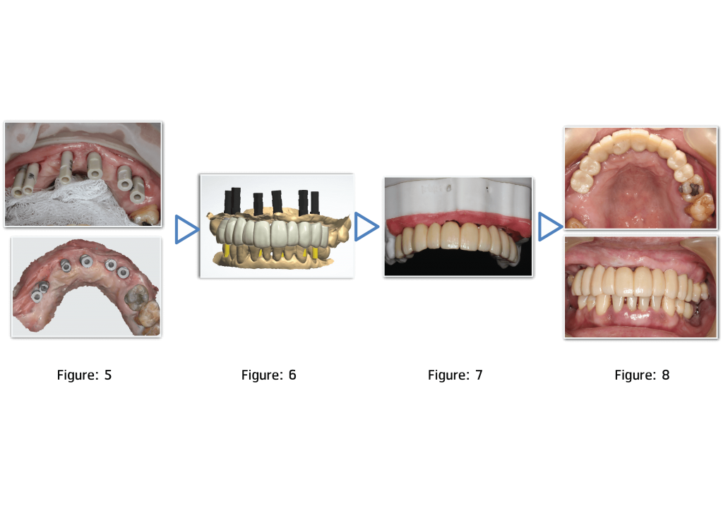 FULL MOUTH DENTAL IMPLANT BY DIGITAL SYSTEM - BFC Dental