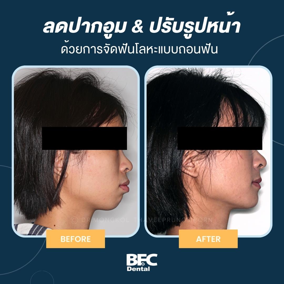 หมดปัญหาขาดความมั่นใจด้วย จัดฟันแก้ปากอูม ฟันยื่น ฟันเหยิน